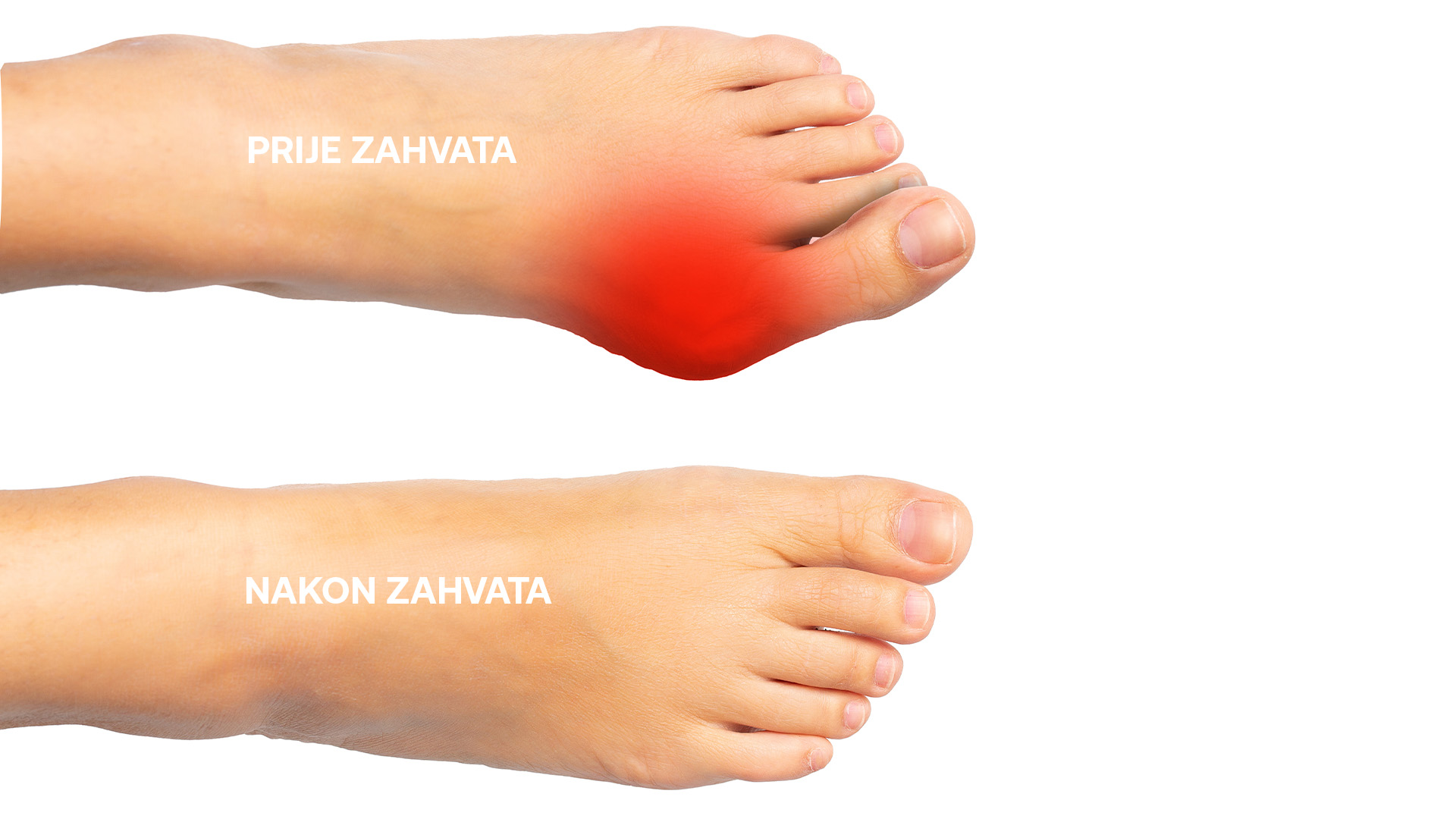 Čukljevi ili hallux valgus: Sve o suvremenoj operaciji stopala